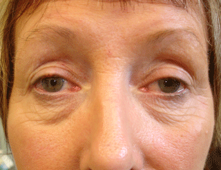 Before and After Photos of Surgery by Mr Richard Caesar